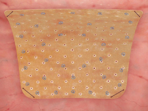 Biodesign Tissue Grafts - Endotherapeutics