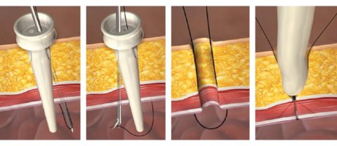 CT CloseSure Port Closure - Endotherapeutics