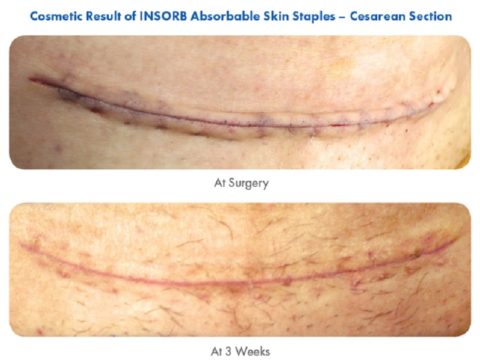 INSORB Absorbable Skin Stapler - Endotherapeutics