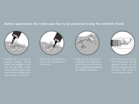 Ovesco remOVE Clip Removal - Endotherapeutics