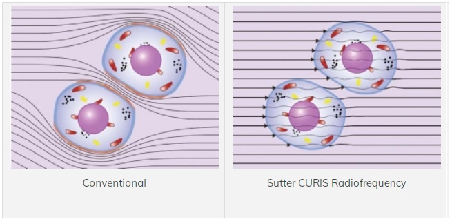 Sutter Curis Radiofrequency Energy Distribution - Endotherapeutics